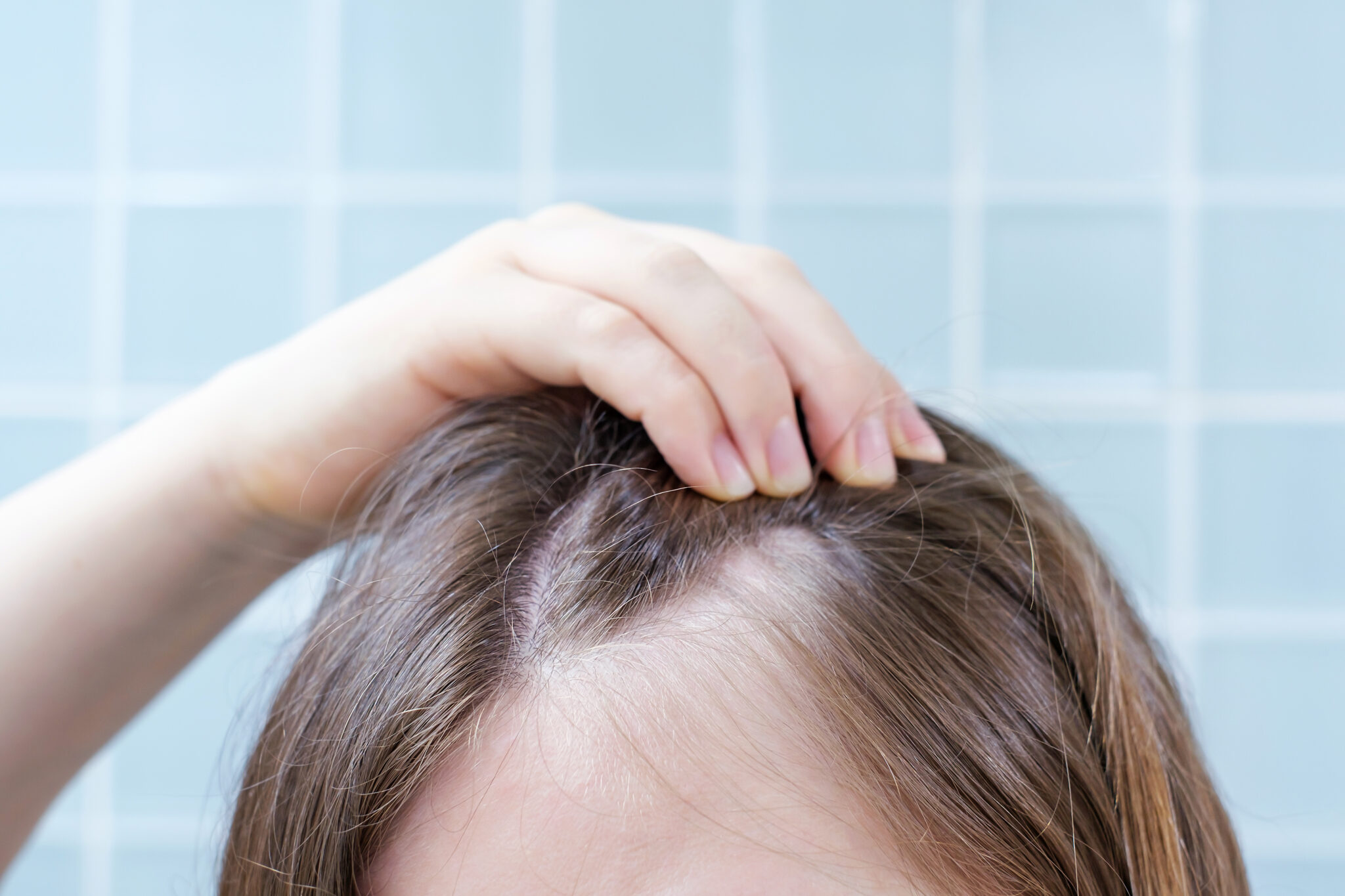 » Summer Sun and Autumn Hair Loss: A Hidden Connection